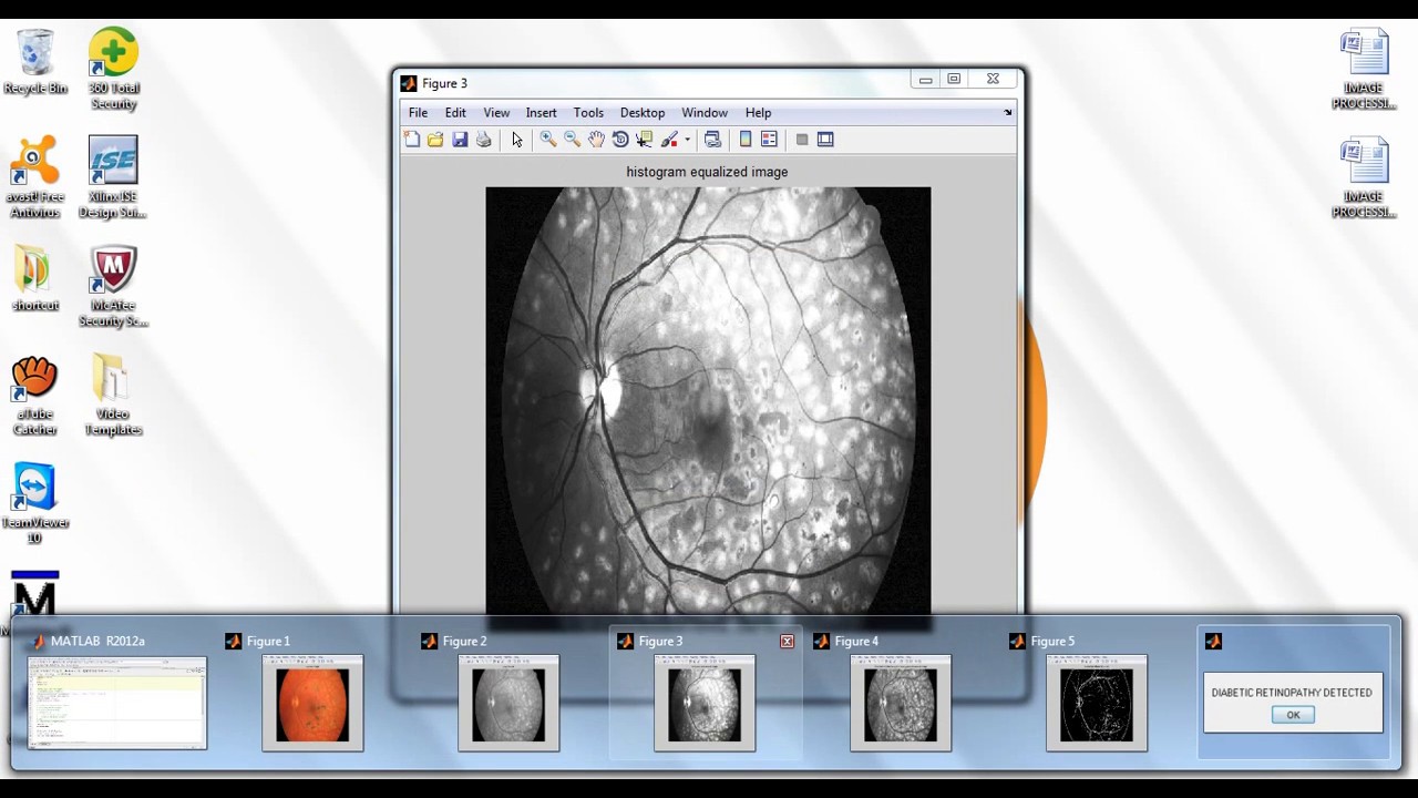 Diabetic Retinopathy Detection Using Matlab Code Final Year Ece Projects At Bangalore