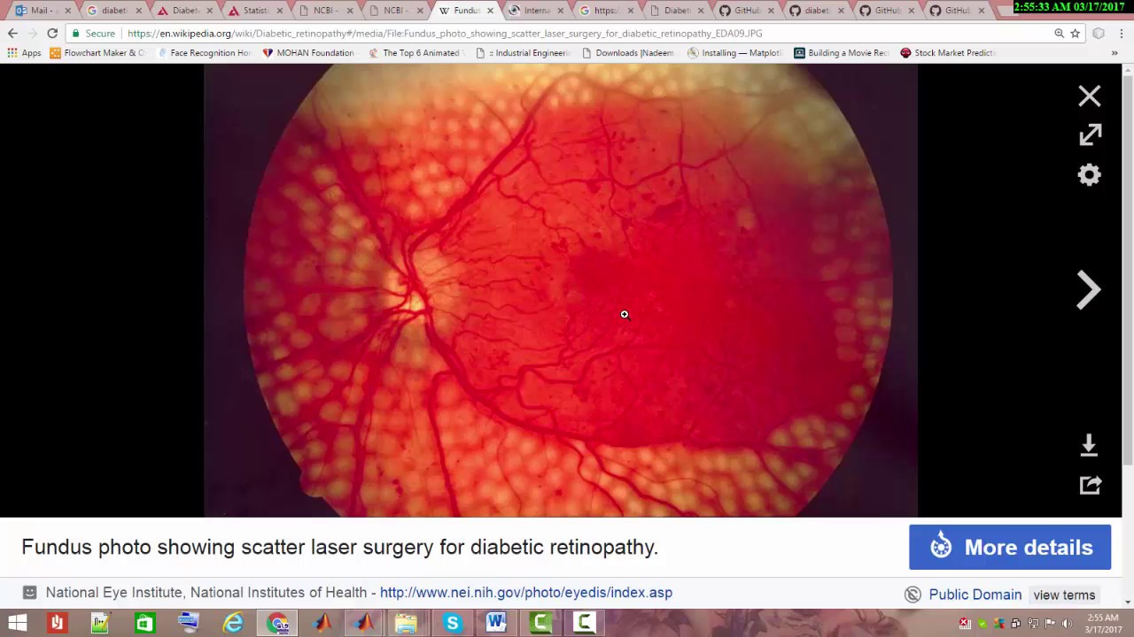 Diabetic Retinopathy Detection Classification Matlab - vrogue.co Diabetic Retinopathy Detection Classification Matlab - vrogue.co