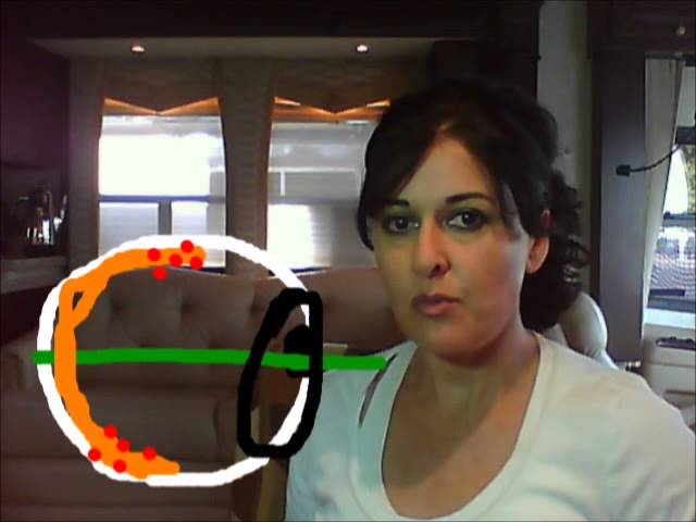 Diabetic Retinopathy (Bleeding in the Eye) - Diabetic.Live