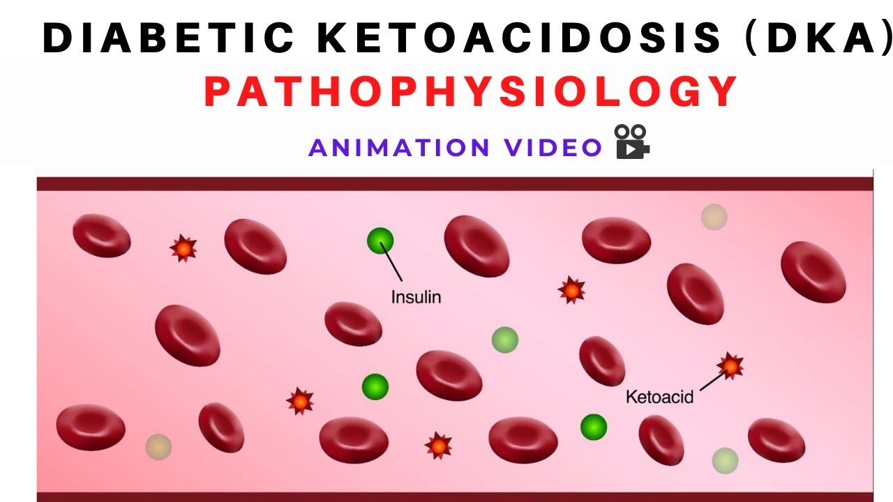 Pathophysiology of Diabetic Ketoacidosis (DKA) - Animation - Diabetic.Live